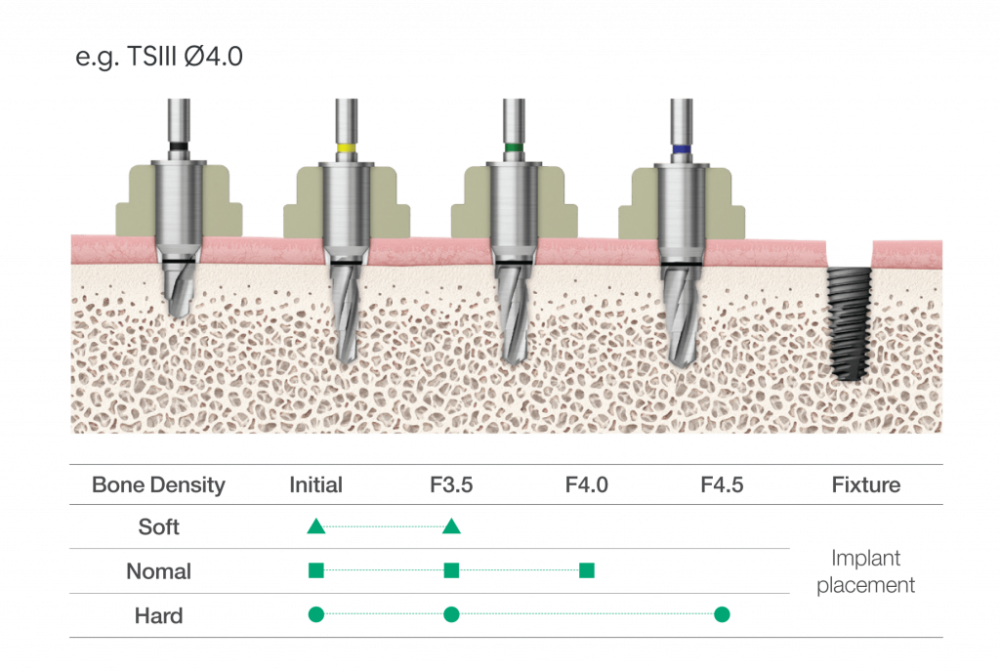 ONE GUIDE KIT OSSTEM – OSSTEM IMPLANT LEBANON
