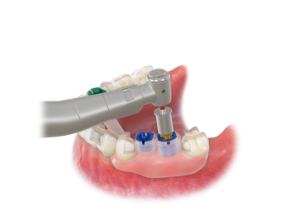 ONE GUIDE KIT OSSTEM – OSSTEM IMPLANT LEBANON